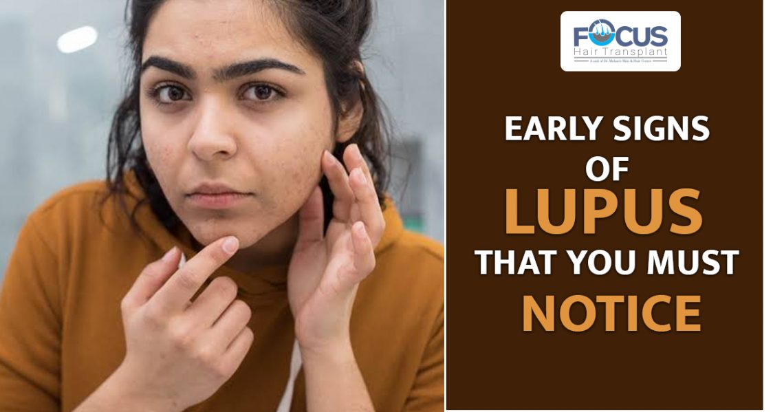 Early signs of lupus