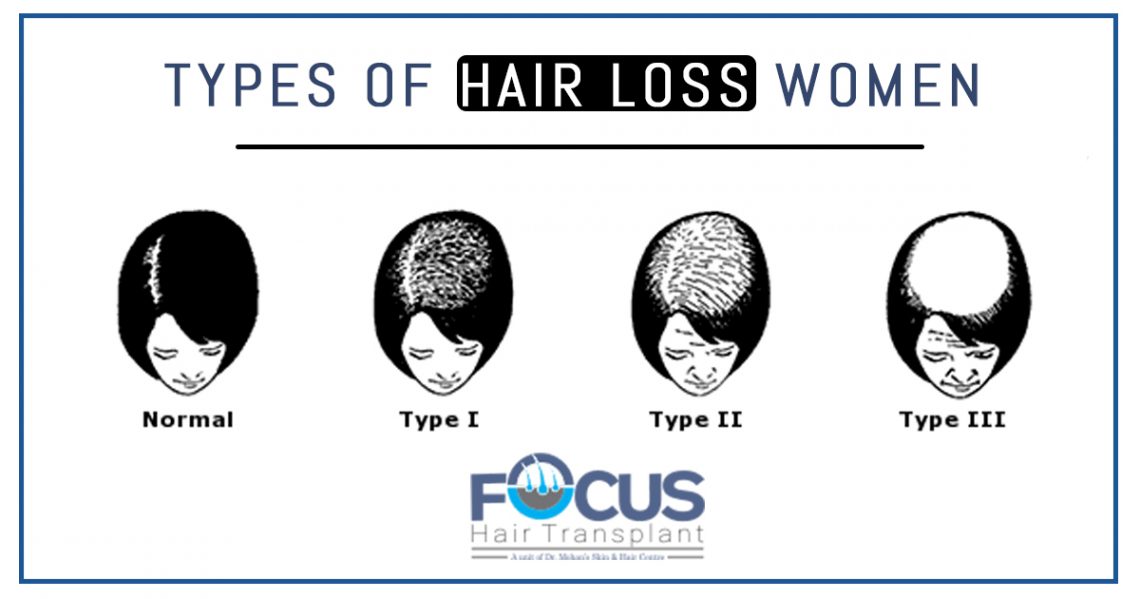 Different Types of hair loss in women